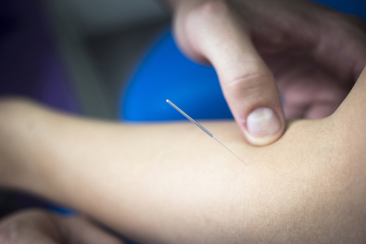 What is Dry Needling? – Physical Therapy Center of Excellence